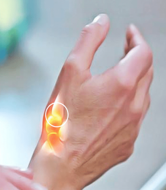 La rhizarthrose - Docteur Faivre Chirurgie de la main