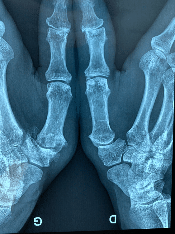 La rhizarthrose - Docteur Faivre Chirurgie de la main